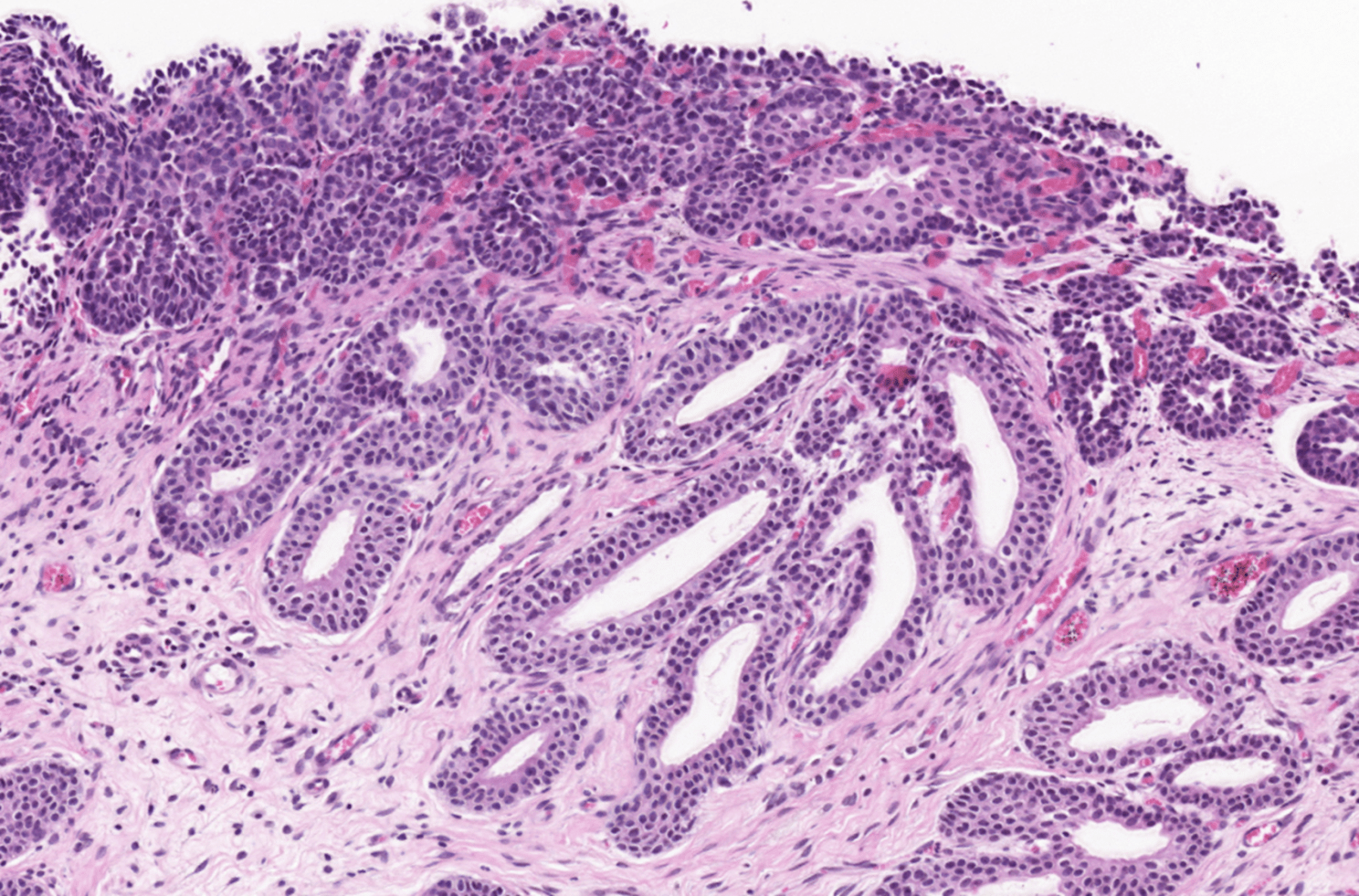 NationWide Laboratories: Cystitis Glandularis in a 13-year-old female ...